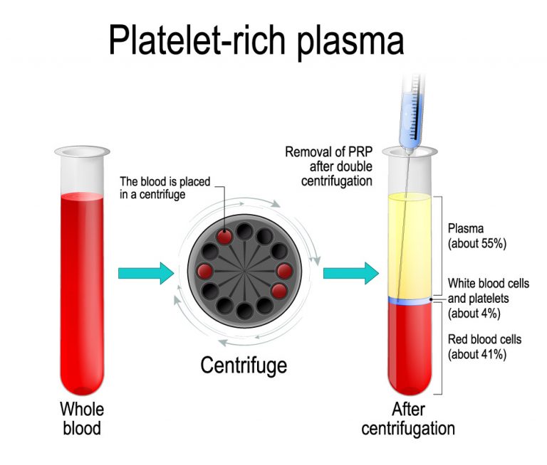 platelet-rich-plasma | Brampton Cosmetic Clinic | Brampton Botox ...